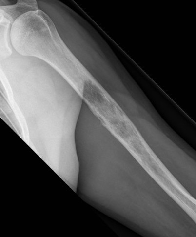 Conventional Osteosarcoma | The Bone School